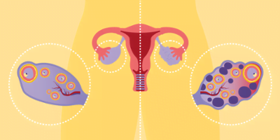 PCOS Fertility : Relationship Between Two and How To Manage?