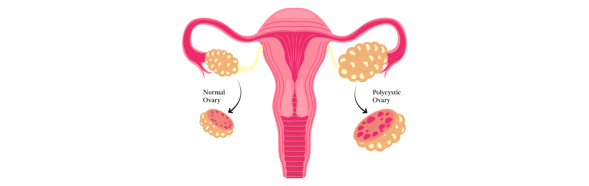 Understanding PCOS: Symptoms and Strategies for Women