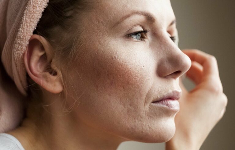 PCOS Skin Discoloration Treatment: Professional & Self-Care